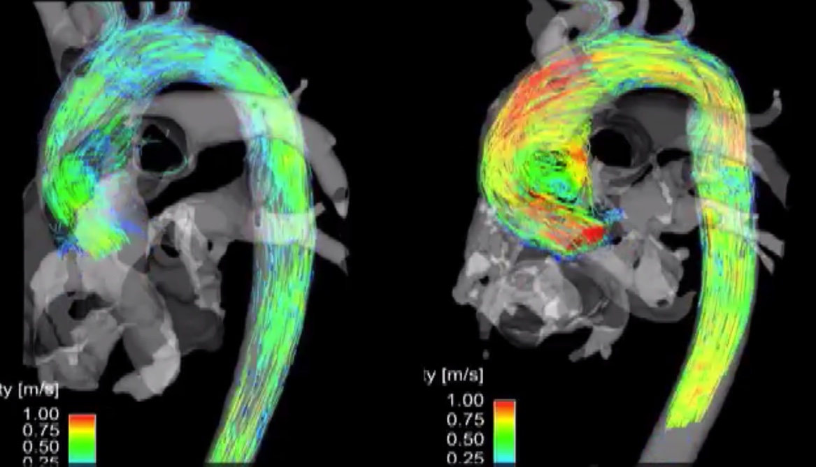 Meg Ivy // 4D Flow MRI - Flow Visualization