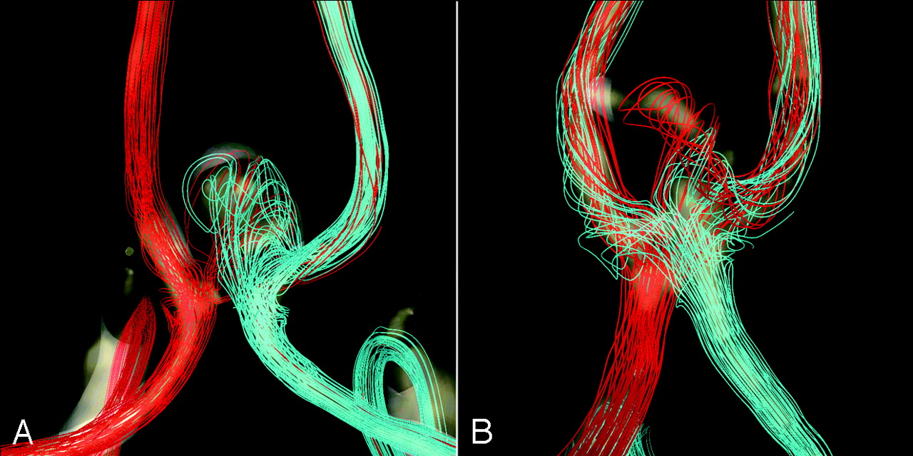 Intra-aneurysmal Flow Distribution - Flow Visualization
